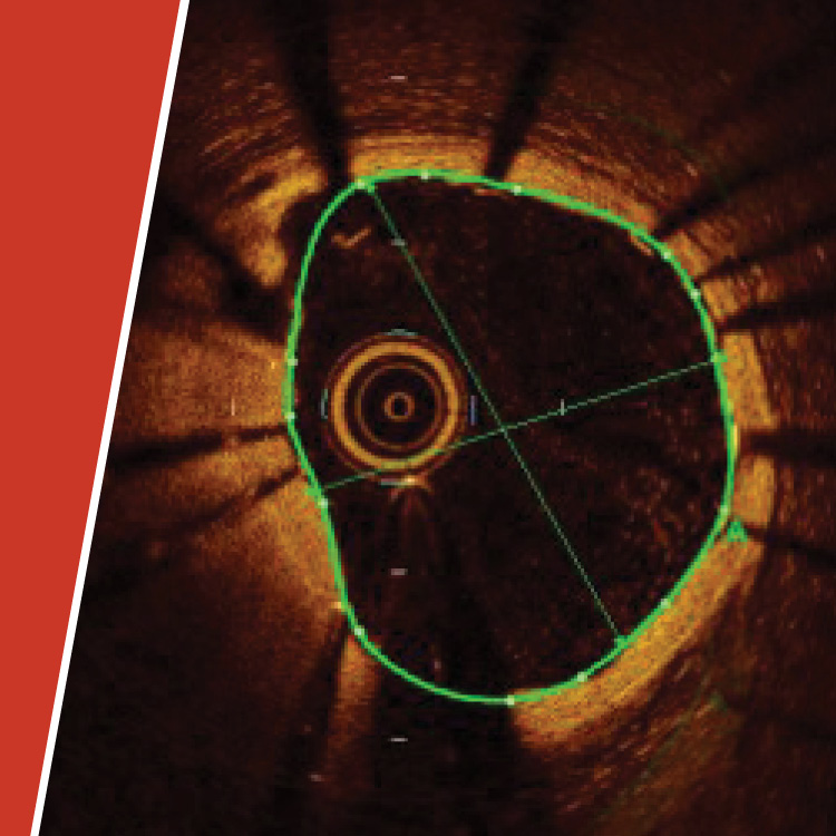 Intravascular Lithotripsy for Treatment of Complex Coronary Lesions ...